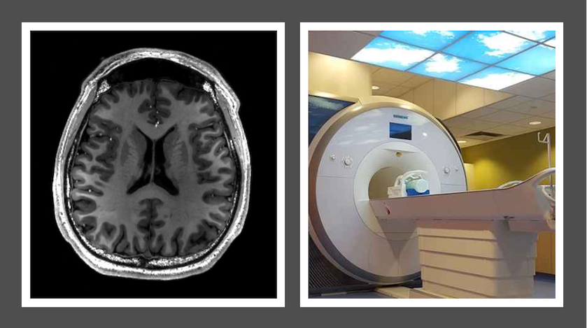 Rally | MRI Study in Older Adults with Schizophrenia or Schizoaffective Disorder