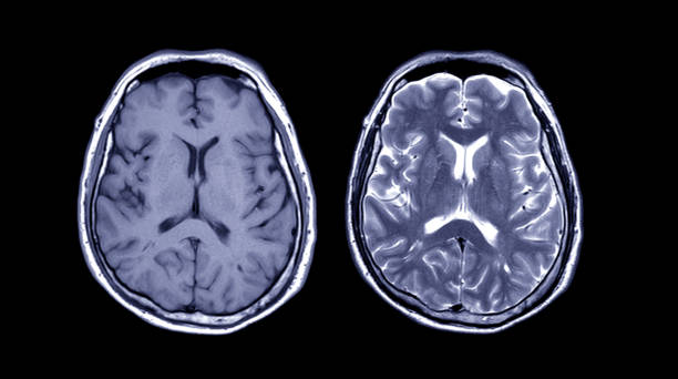 Rally | Neural Basis of Loneliness in Mental Illness - Individuals with ...