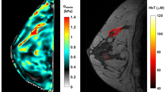 Rally | Breast Cancer Imaging with Combined Functional Optical and Magnetic Resonance Imaging