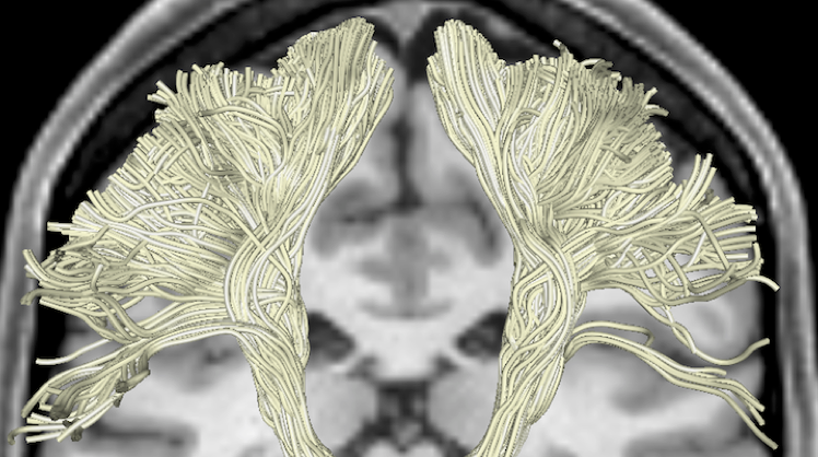 Rally | MRI Study on Brain Connectivity for Parkinson's Disease